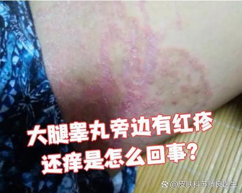 阴囊癣的症状和图片图标