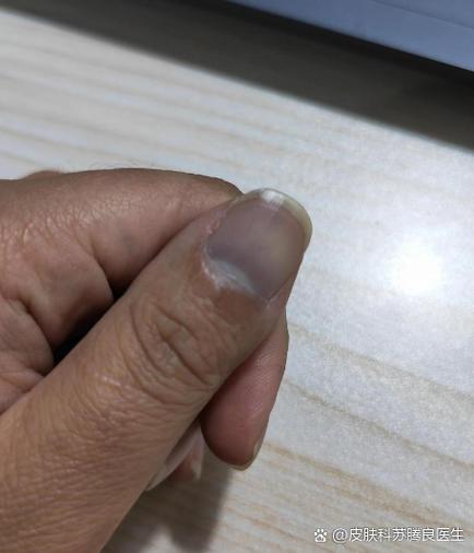 指甲发紫有竖纹图标