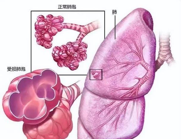肺大泡是啥病图标