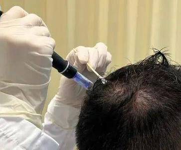 男士治疗脱发最好方法图标