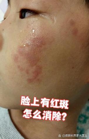 脸上的红斑如何去除图标