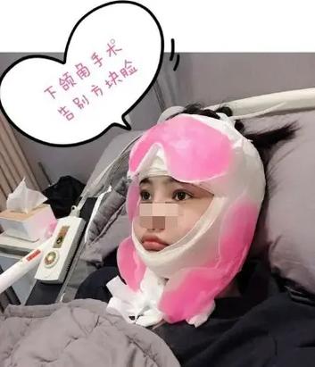 脸部削骨有什么风险