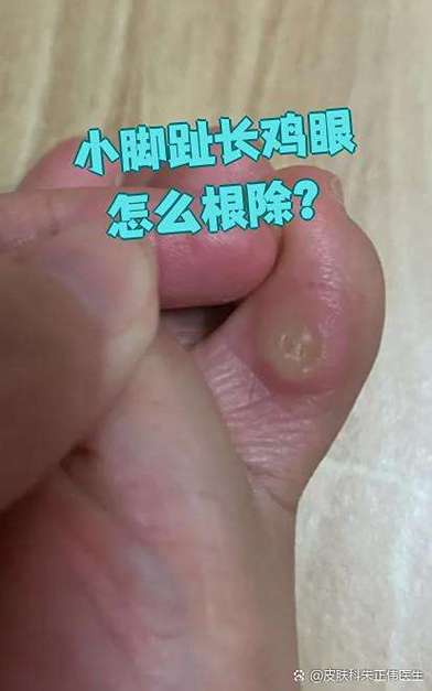 治疗肉刺最好的治疗方法图标