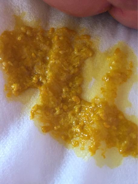 橙色的大便怎么回事