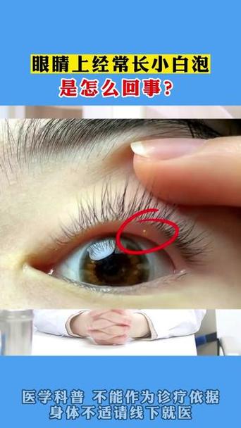 上眼皮泡是什么原因截图