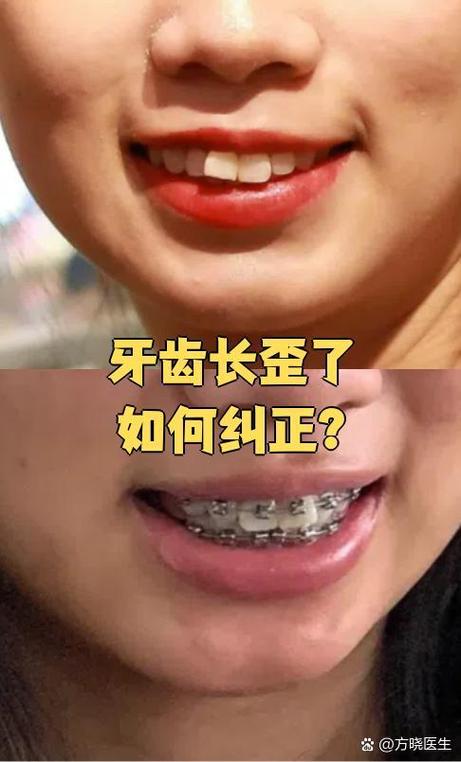 牙齿有一点歪需要矫正吗图标