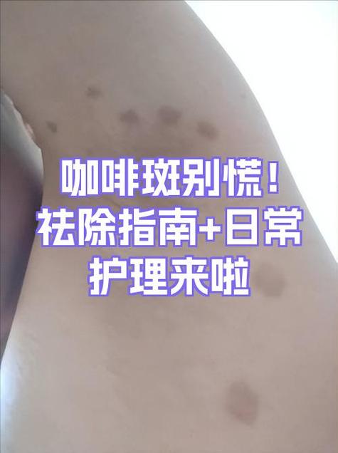 咖啡斑能彻底去除吗图标