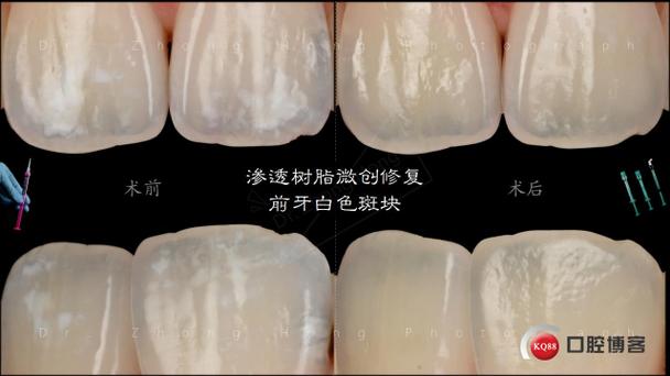 苹果8后盖玻璃有白色斑点图标