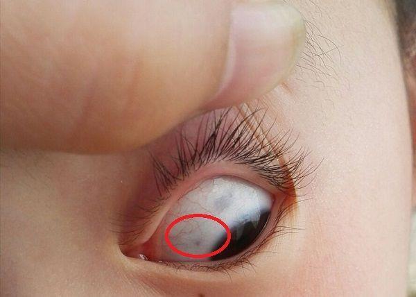 眼睛有蓝点是什么原因?图标