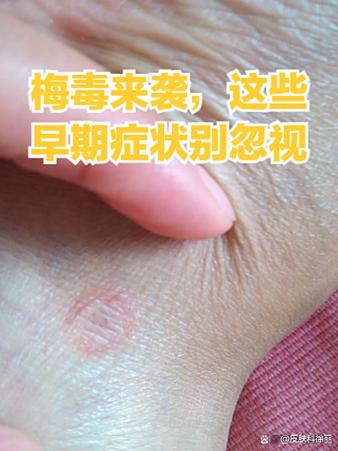 感染梅毒40年自己都不知道图标