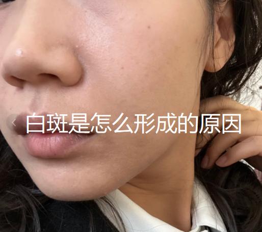 皮肤颜色不均匀有白色截图