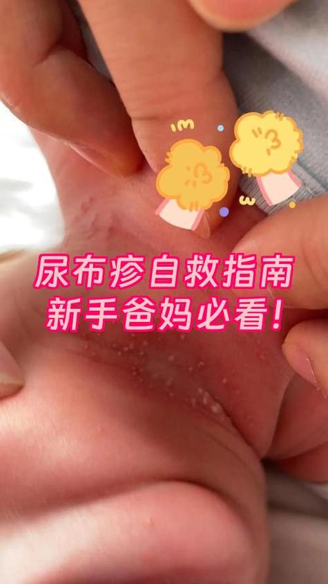 尿布疹怎么护理才能好