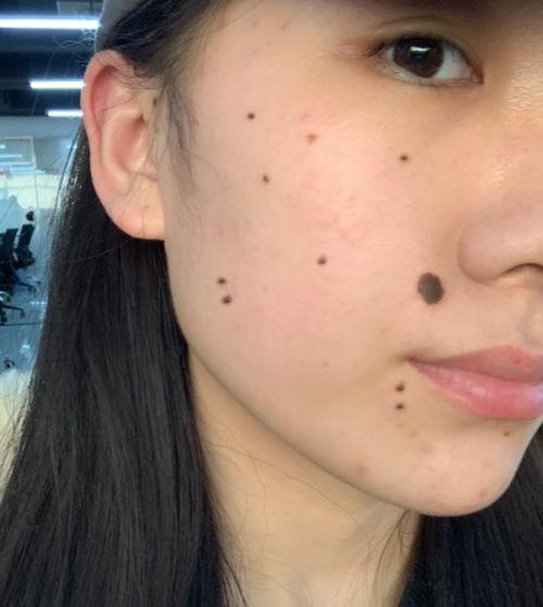 视频可以把痣p掉吗图标