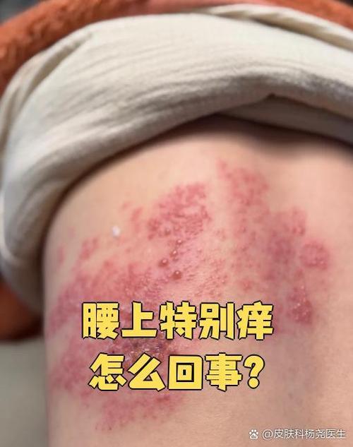 后腰痒痒咋回事图标