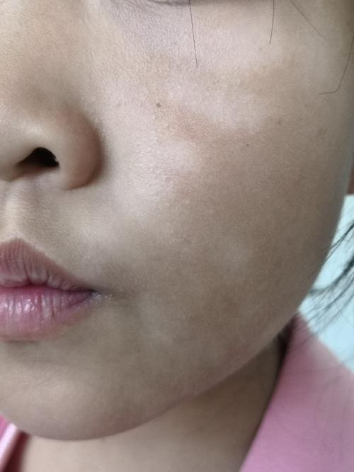 脸上起白色的小白点图标