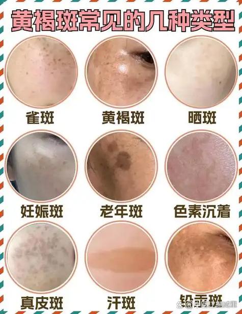 各种斑的图片及名称图标