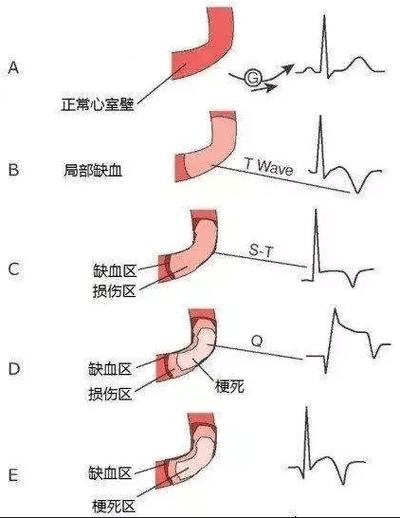心脏供血不足早期症状图标