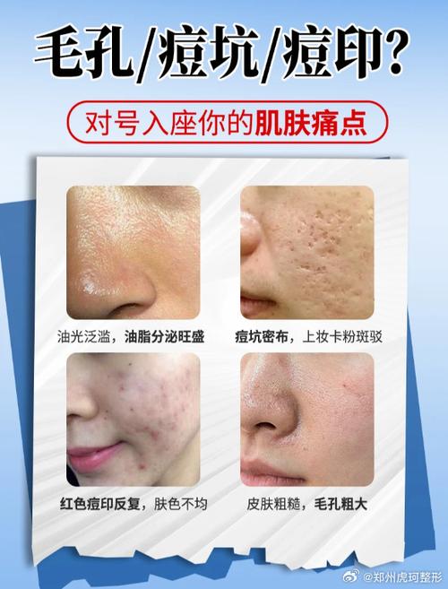 痘坑磨皮手术效果图图标