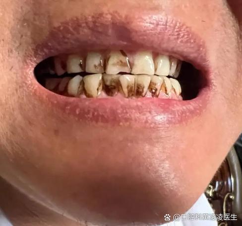 53岁牙齿松动是什么原因