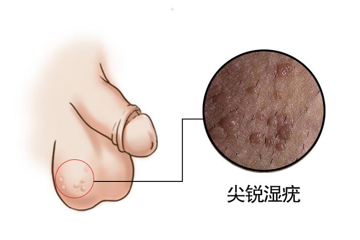 男性私处长了小肉粒怎么回事图标