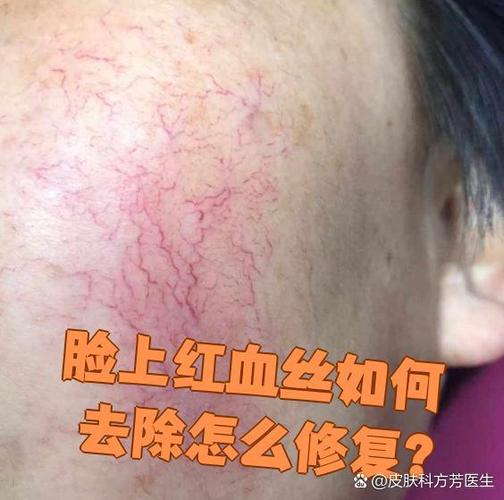 红血丝怎样治好图标