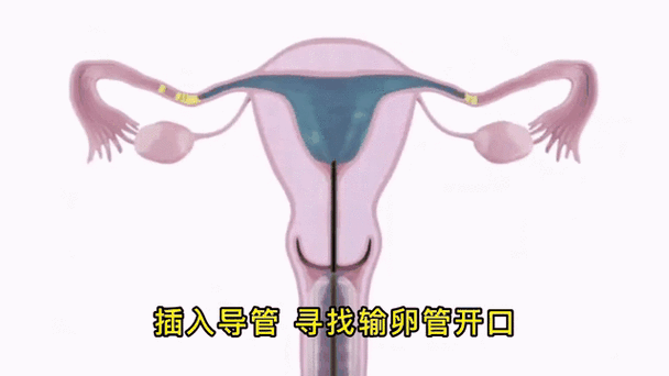 做一次输卵管疏通要多少钱图标