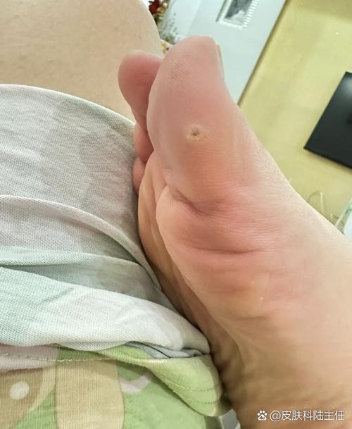 肉刺的症状和图片图标
