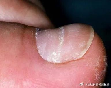 博氏线是癌症的早期信号吗图标