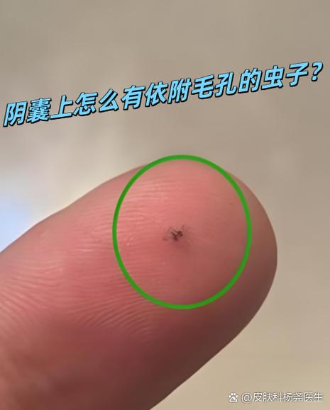 长在阴囊上的虫子