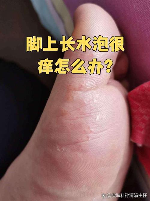 脚有水泡很痒怎么办图标