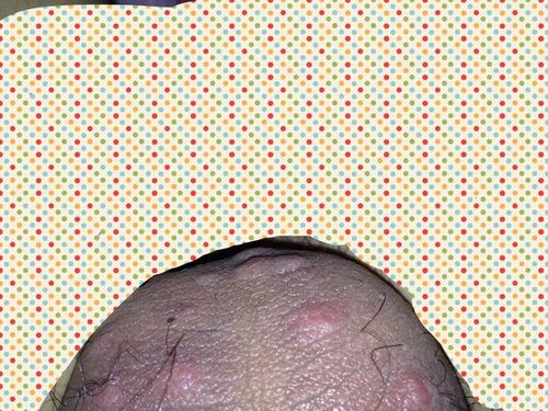 蛋皮上有疙瘩很痒图标
