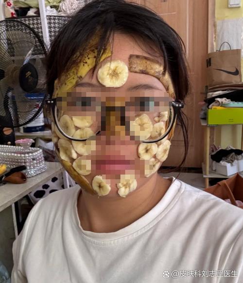 香蕉涂脸上管过敏吗图标
