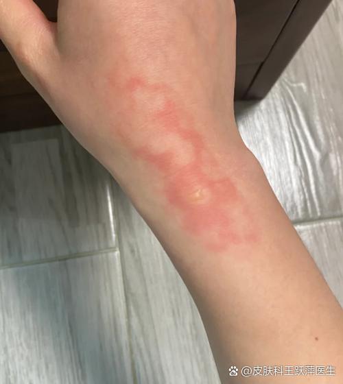 被开水烫了只是红了用涂药吗图标
