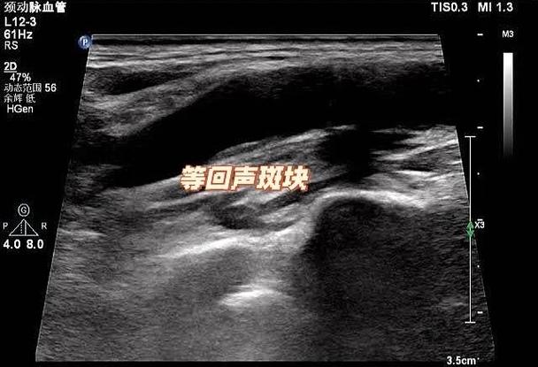 颈部斑块高回声和低回声有何区别图标