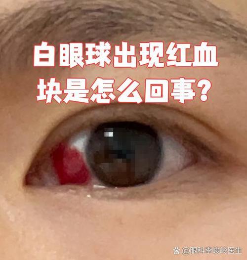 眼睛里有红血块是什么原因图标