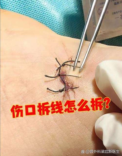缝三针多久拆线图标