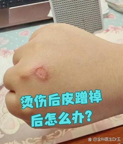 烫伤后三天皮被搓掉了截图