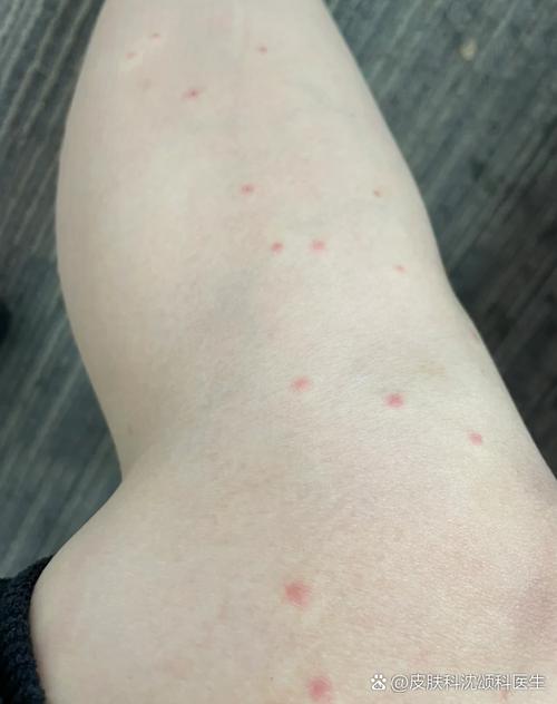 腿上长红包截图