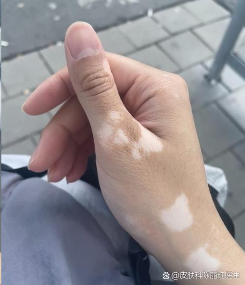 皮肤一会白一会黑