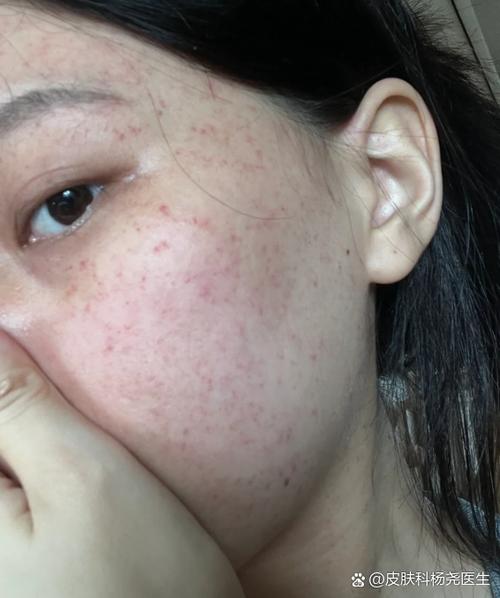 脸上红点点图标