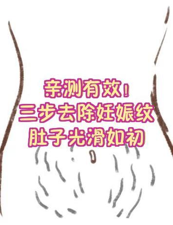 妊娠纹怎么去除最好的办法是什么图标