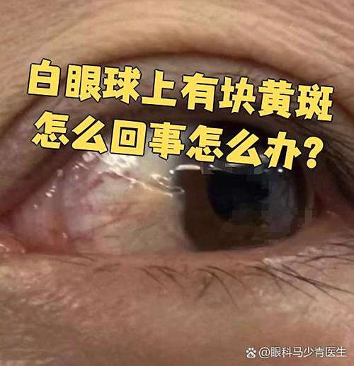 眼白上有一小块黄斑图标