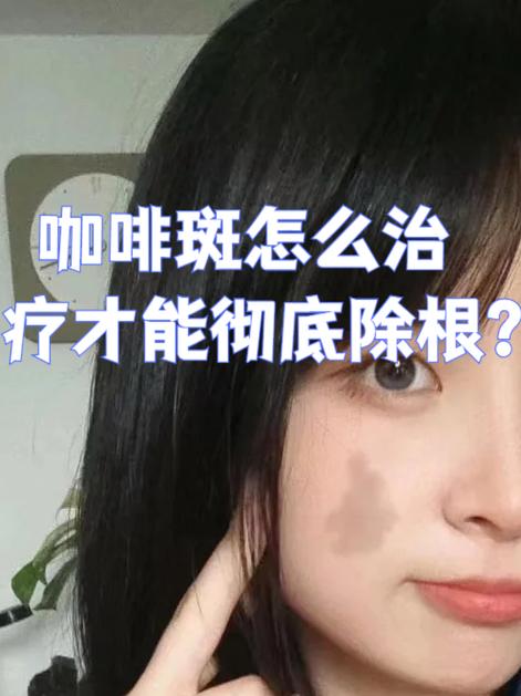 咖啡斑可以根治吗图标