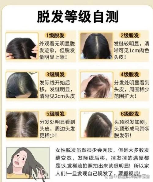 女人脱发的主要原因截图