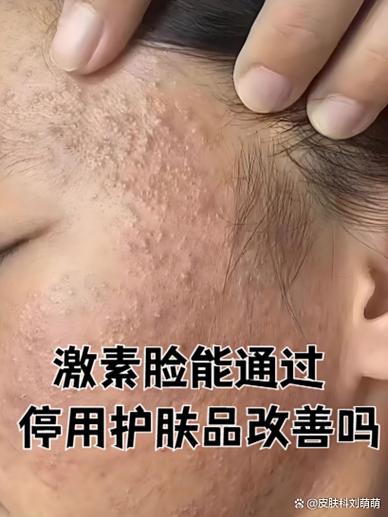 脸部皮肤屏障受损怎么修复