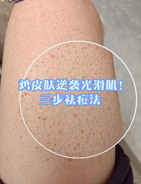 皮肤变成鸡皮肤原因图标
