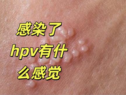 hpv的疣体长什么样子图标