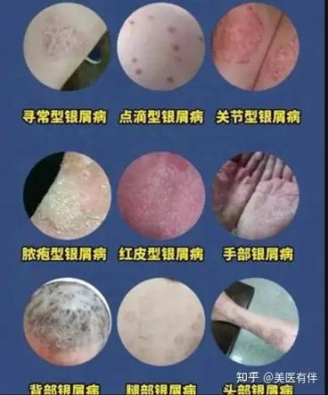 银屑病寿命一般多少年图标