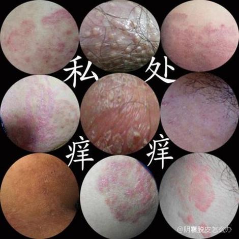 蛋皮瘙痒脱皮