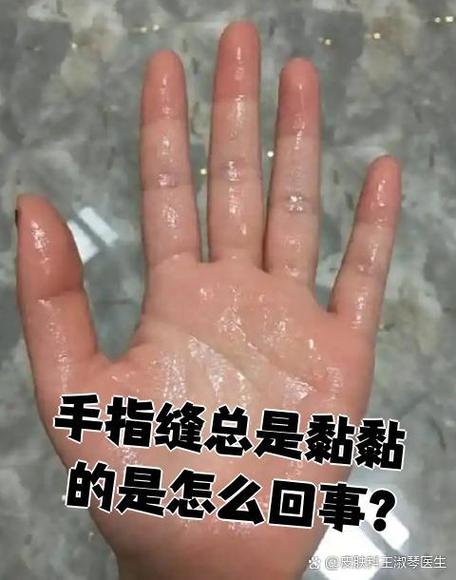 睡醒觉手指缝感觉是粘的图标